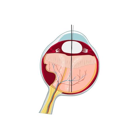 Premium Vector Retinal Detachment
