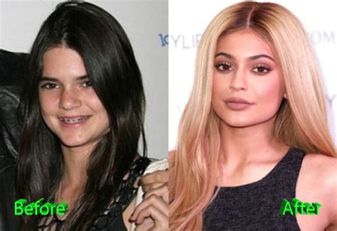 Kylie Jenner Plastic Surgery Facts Rumors And News