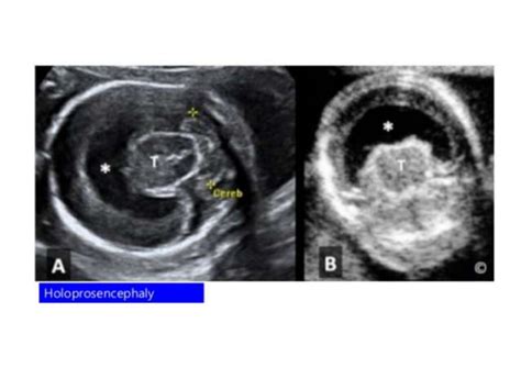 Fetal Anomaly Scan Pptx Pregnancy Reproductive Health