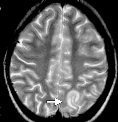 Vasculitis Brain