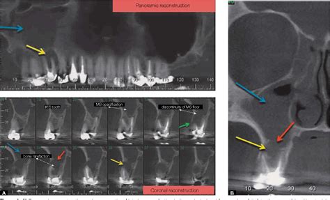Disease Of Maxillary Sinus Semantic Scholar