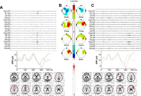 individual examples of eeg trace c erp p300 response b absolute