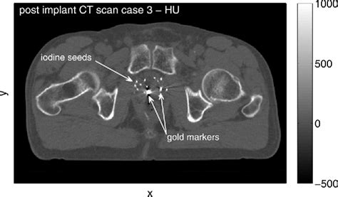 Figure 1 From Dose Reduction In Ldr Brachytherapy By Implanted Prostate
