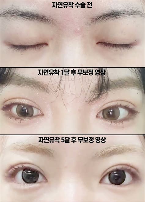 비대칭 눈 자연유착 쌍꺼풀 무보정 경과영상 💡 프라미스성형외과 Shorts Youtube
