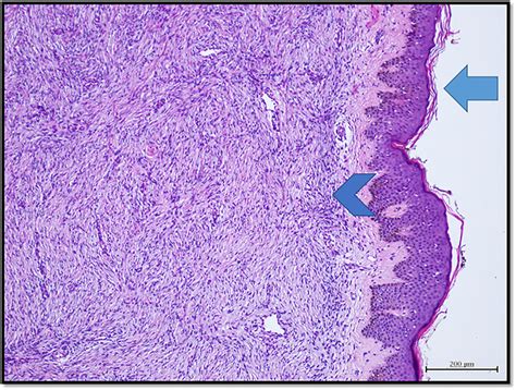 Section Reveal Atrophic Skin Arrow With An Underlying Spindle Cell Download Scientific