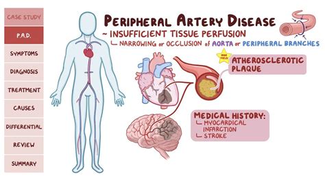 Arterial Vascular Disease Symptoms Iloc