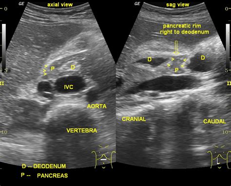 Annular Pancreas Ultrasound