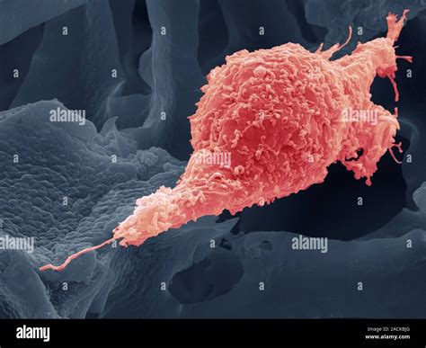 Cervical Cancer Cell Coloured Scanning Electron Micrograph Sem Of A Cultured Cancer Cell From