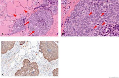 Thyroid Metastasis From Cervical Carcinoma Brazilian Journal Of Otorhinolaryngology