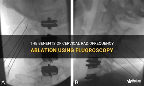 The Benefits Of Cervical Radiofrequency Ablation Using Fluoroscopy