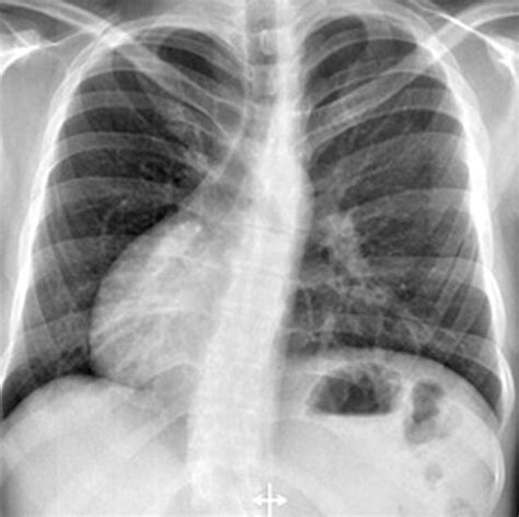 Dextrocardia Treatment Symptoms Diagnosis Causes Pictures Hubpages