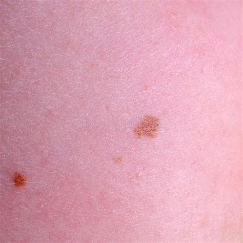 Nevus Or Mole On The Human Body Close Up Skin Cancer Keratosis Or