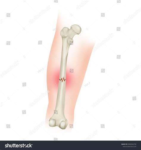 Transverse Bone Fracture Femoral Shaft Fracture Stock Illustration