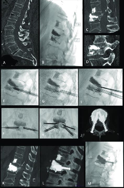 Patient 3 A CT Scan Showing Fracture Of L1 With Airfilled Cleft And Download Scientific