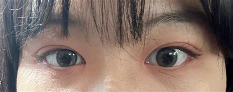 차이성형외과 실력의 차이가 결과의 차이전후사진후기리얼셀피 후기