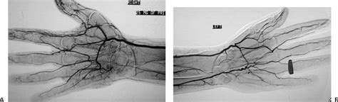 22 Hypothenar Hammer Syndrome Radiology Key