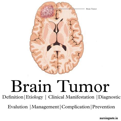 Brain Tumor 2nd Year Gnm Medical Surgical Nursing Ii Oncology Nursing Definition Types