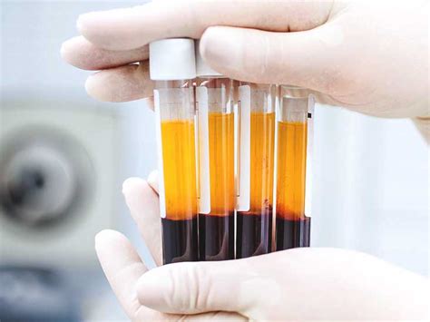 Platelet Rich Plasma Prp Therapy London Uk Prp Treatment London Uk