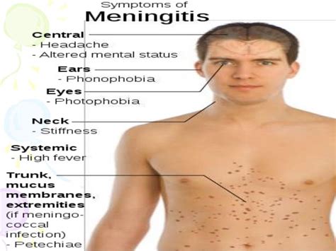 Viral Meningitis Rash Pictures Shingles Rash In Leukaemia Patient