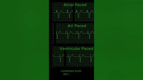 Atrial Vs Ventricular Vs Av Pacing 42 Second Cardiac Breakdown Youtube