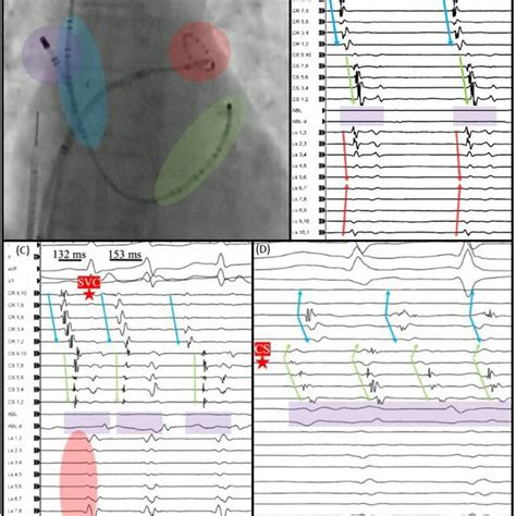 Example Of The Catheter Setup During Isoproterenol Provocation Test And Download Scientific