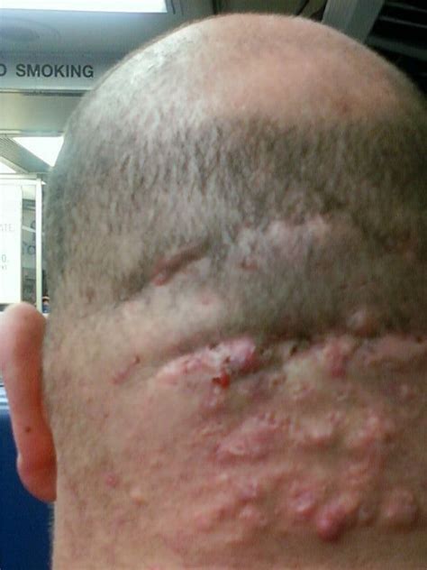 Home Remedies Acne On The Scalp Hair Natural Treatment