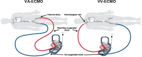 Aa Schematic Representation Of Peripheral VA VA ECMO And VV ECMO Download Scientific Diagram