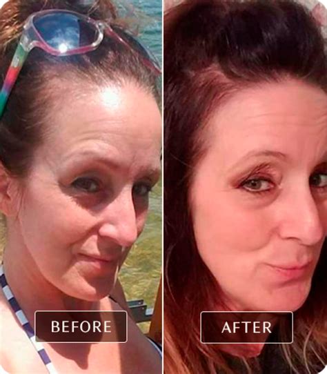Hair Growth Before And After Results Ashley Black