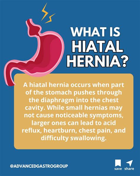 Advanced Understanding Hiatal Hernia This Condition Occurs When Part