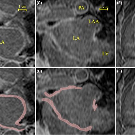 The Measurement Of The Atrial Wall Thickness In Our Representative