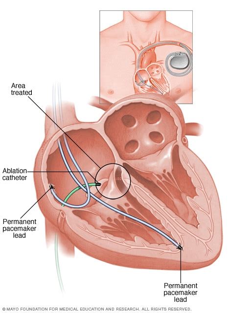 Sick Sinus Syndrome Diagnosis And Treatment Mayo Clinic