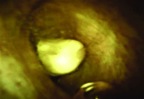 Impacted Stone Surrounded By Sludge On Cholangioscopy Download