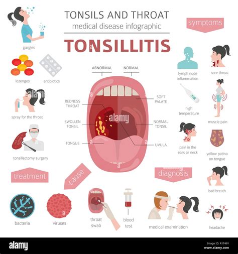 Tonsils And Throat Diseases Tonsillitis Symptoms Treatment Icon Set
