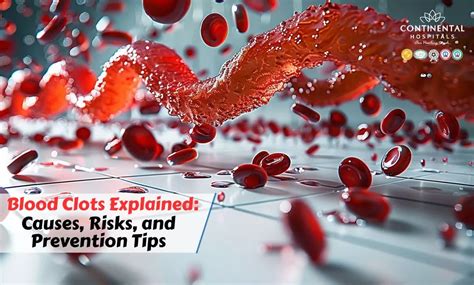 Blood Clots Explained Causes Risks And Prevention Tips