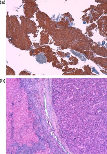 A Biopsy Specimens Of The Gist With Immunoexpression Of C Kit 40x