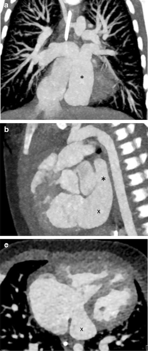 Type 2 Cardiac Total Anomalous Pulmonary Venous Connection Tapvc