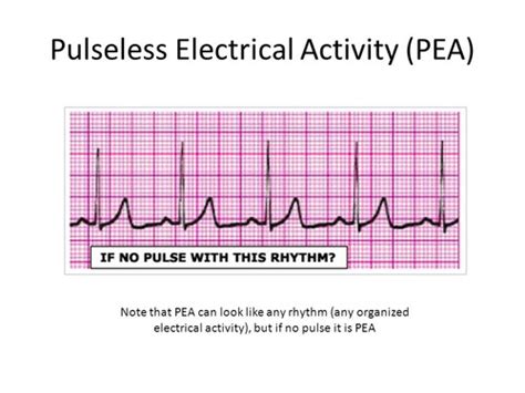 Pulseless Electrical Activity Pulseless Electrical Activity In The