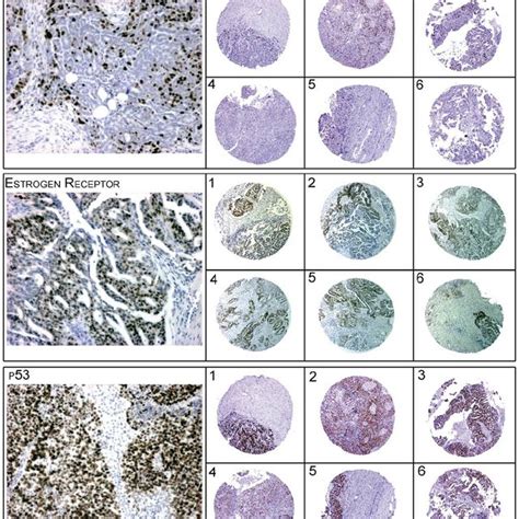 Pdf Validation Of Tissue Microarray Technology In Ovarian Cancer