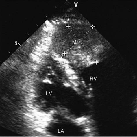 Transthoracic 2 D Echocardiography Shows About A 3×4 Cm Sized Mass