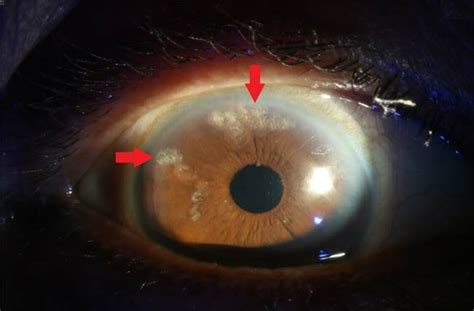 Six Months After Cataract Surgery In The Right Eye Note The Lpi Scars Download Scientific