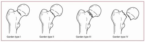 Open Reduction And Internal Fixation Of Femoral Neck Fractures