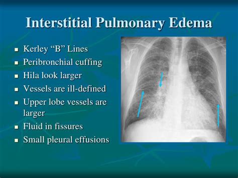 Chest X Ray Pulmonary Edema Vs Pneumonia At Beth Meeks Blog