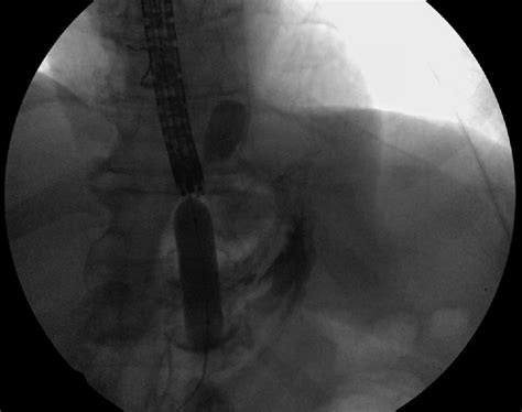 Relief Of Malignant Gastric Outlet Obstruction With Lumen Apposing
