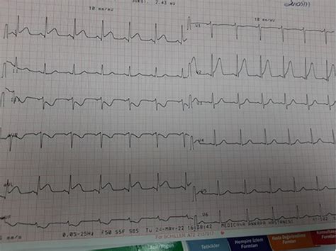 New Ecg Algorithm For The Prediction Of Culprit Vessel Ijgm