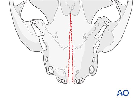 Palatal Intraoral Splint Fixation For Midface Palatal Fracture