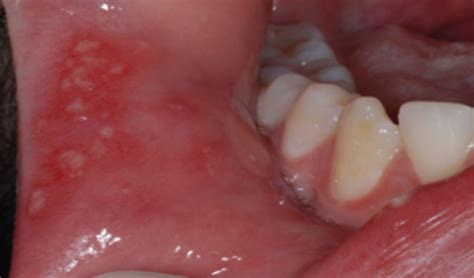 Alovex E Afte Microbiologia Italia