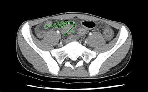 The Region Of Phlegmon In The Adjacent Ileal Mesentery Measuring About