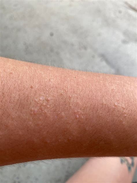 What Is The Little Bump On My Arm At Judith Poche Blog