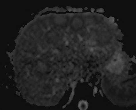 Liver Atlas Diagnosis Metastasis Cholangiocarcinoma