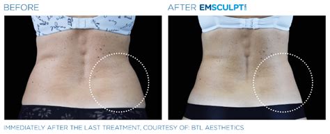 Love Handles Emsculpt Neo Treatment At Shape Med Centers